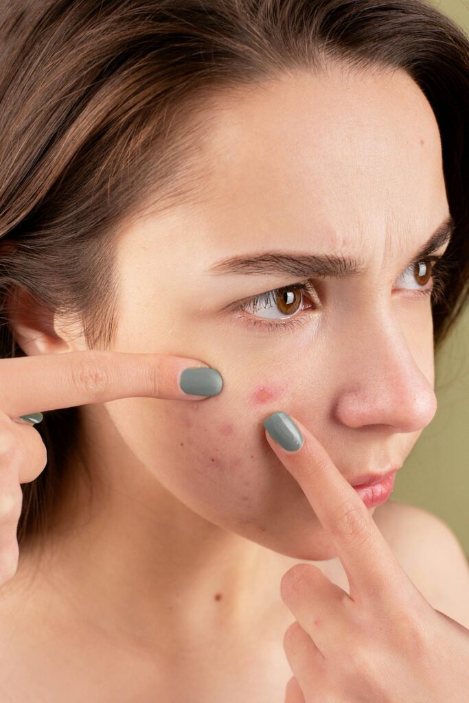 How To Get Rid Of Pimples Fast: The No Bullsh*t Guide
